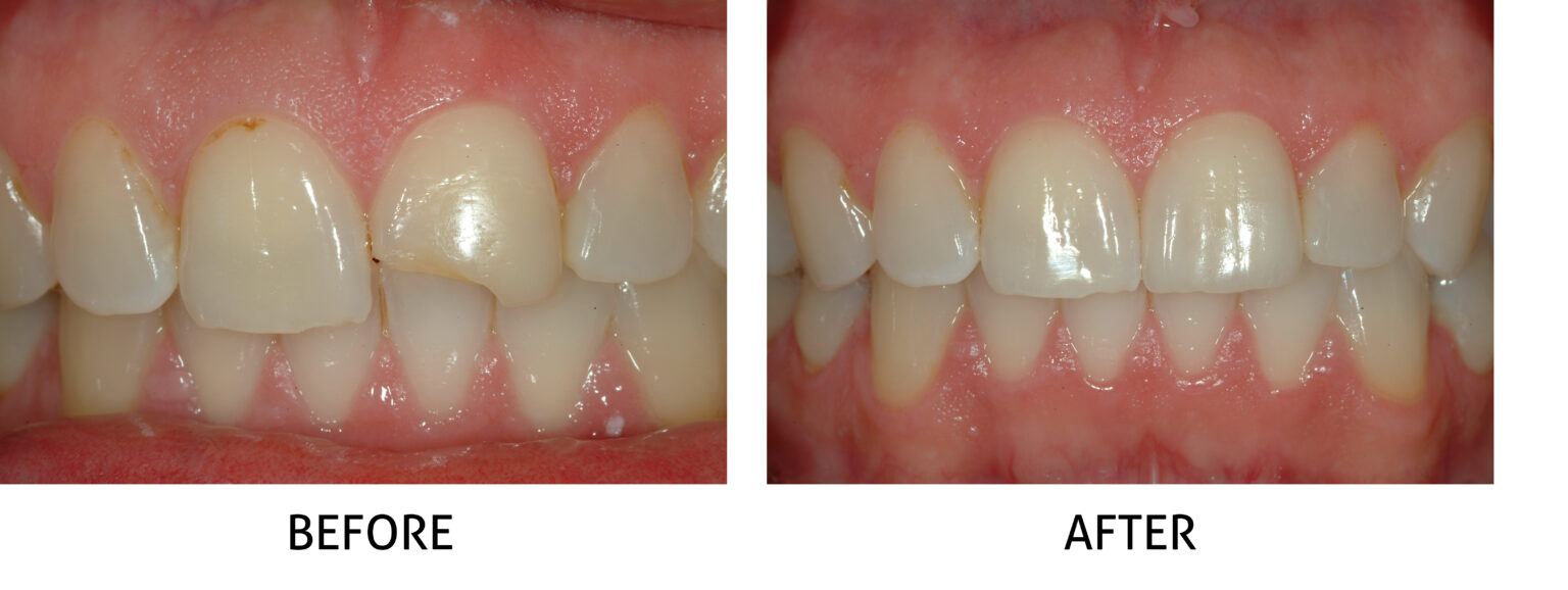 A SINGLE VENEER AND BONDED FILLING—CASE STUDY | Bellingham Dentist ...