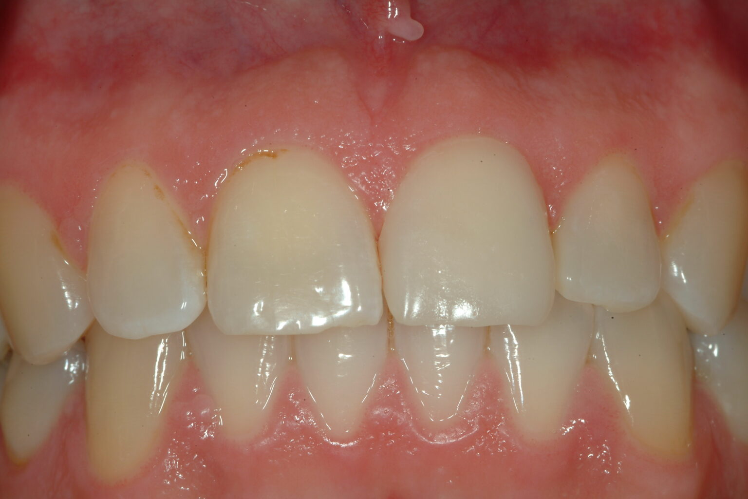 A SINGLE VENEER AND BONDED FILLING—CASE STUDY | Bellingham Dentist ...