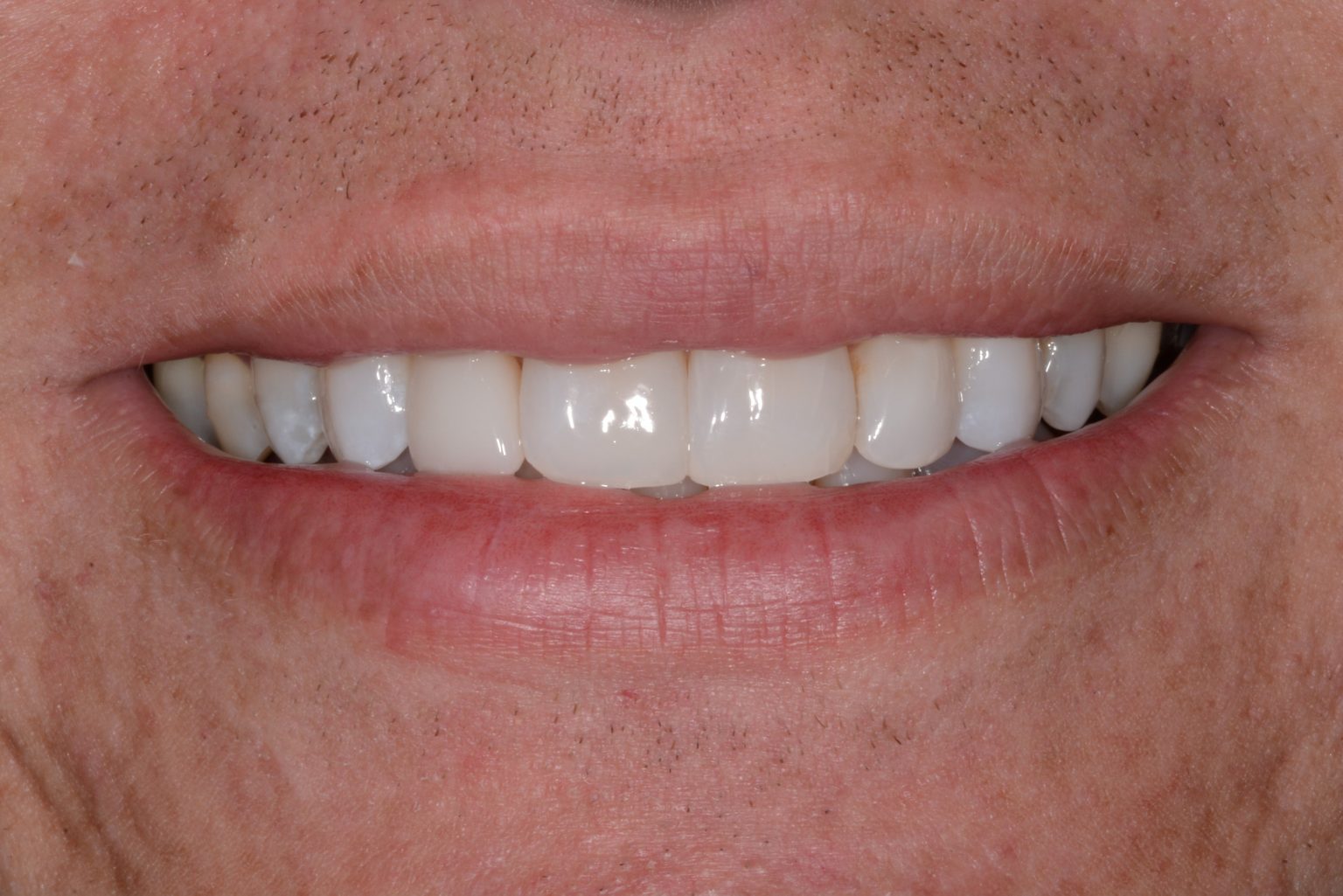 Veneer and Bonded Fillings—Case Study | Bellingham Dentist | Northside ...